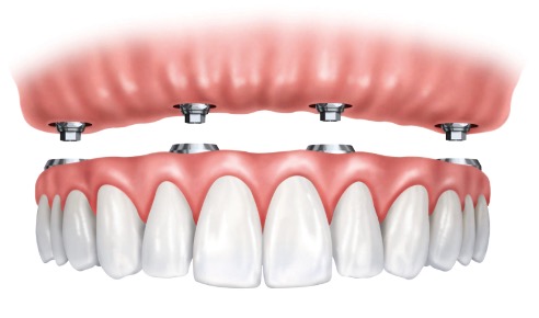 Three Dangers of Tooth Loss and Poor Fitting Dentures · Center for ...