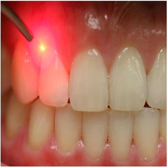 Achieving a Brighter Smile with Lasers In Modern Dentistry · Center for ...