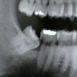 Wisdom Teeth & Root Canals: Understanding the Pain, Process, & Purpose ...